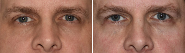 Plastic Surgery Case Study - Custom Implant for Vertical Orbital ...