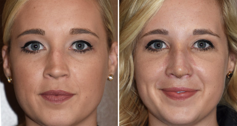 Early Nose Appearance after Rhinoplasty Dressing Removal - Explore ...