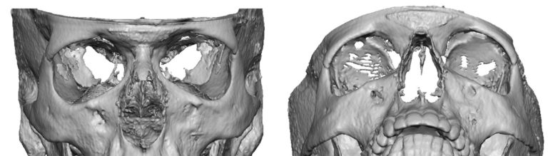 Plastic Surgery Case Study - Custom Implant for Vertical Orbital ...
