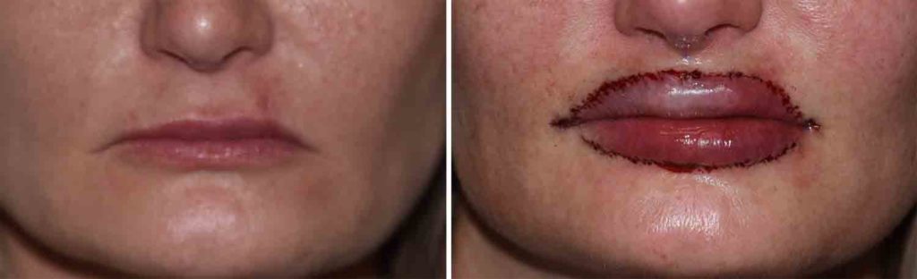 Plastic Surgery Case Study - Extreme Upper and Lower Lip Advancements ...