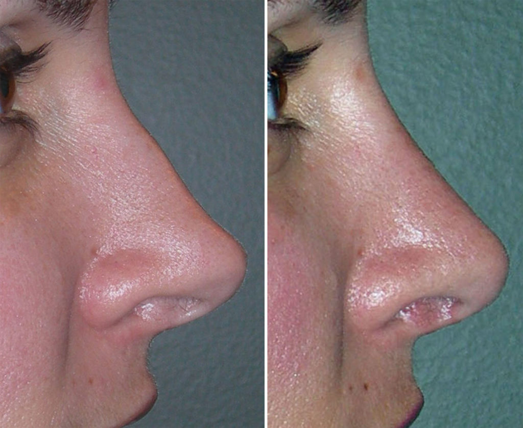 Finesse Female Rhinoplasty result side view Dr Barry Eppley ...