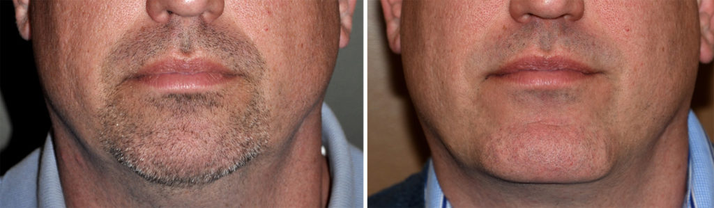 Considerations in the Use of Square Chin Implants in Men - Explore ...