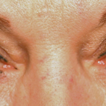 Upper Eyelid Approach for Corrugator Muscle Resection (Reducing the ...