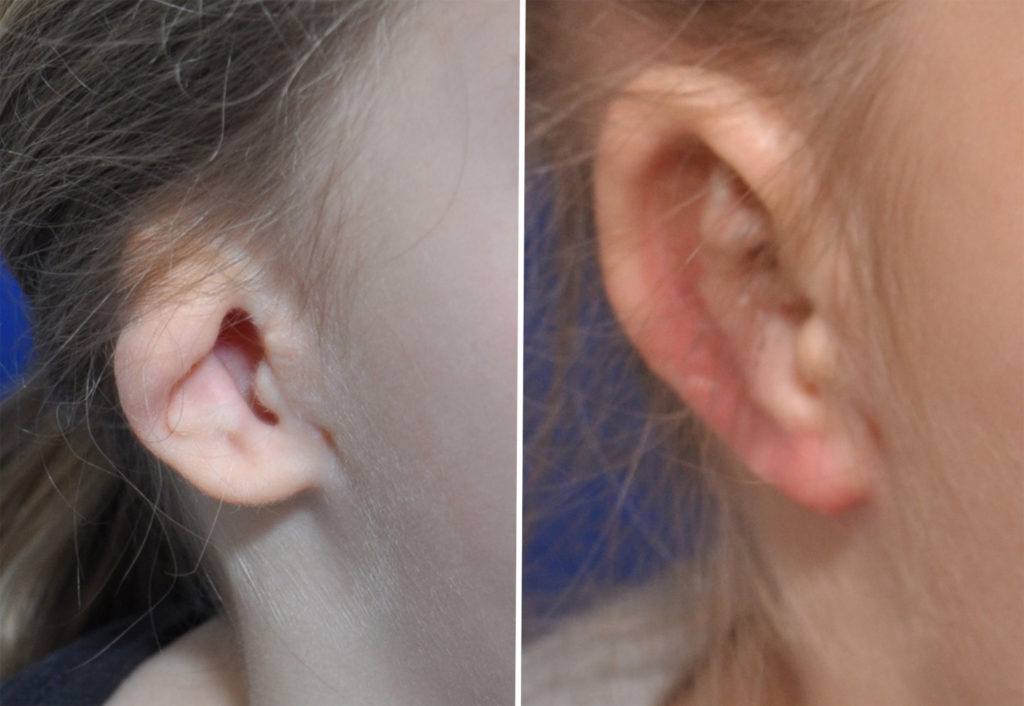 Constricted Ear Reconstruction result oblique view Dr Barry Eppley ...