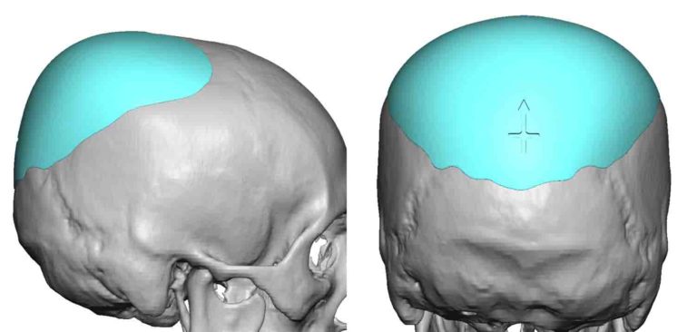 Plastic Surgery Case Study - Custom Occipital Skull Implant for Crown ...