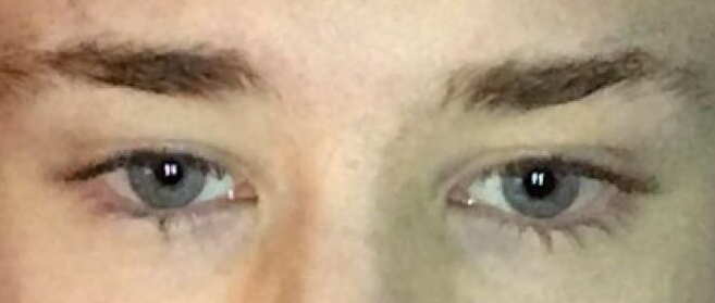 Epicanthal folds in eyes with a distinct eyeliod crease - Explore ...