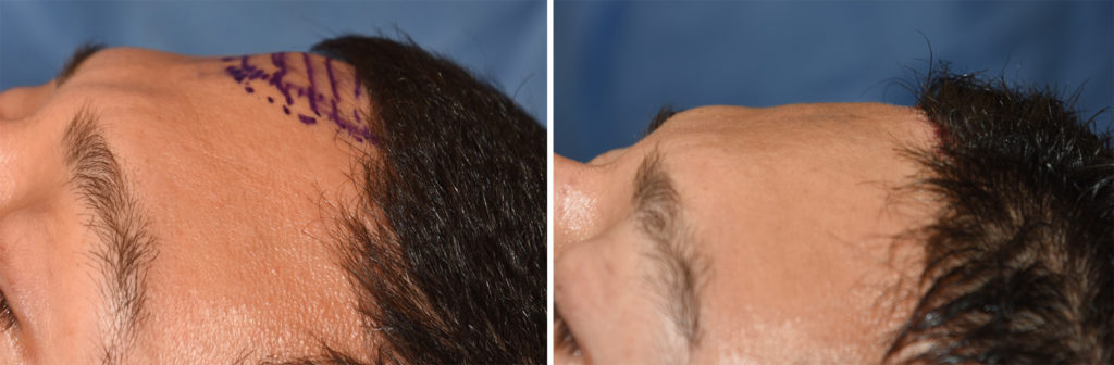 Plastic Surgery Case Study - Reduction of a Prominent Upper Forehead ...