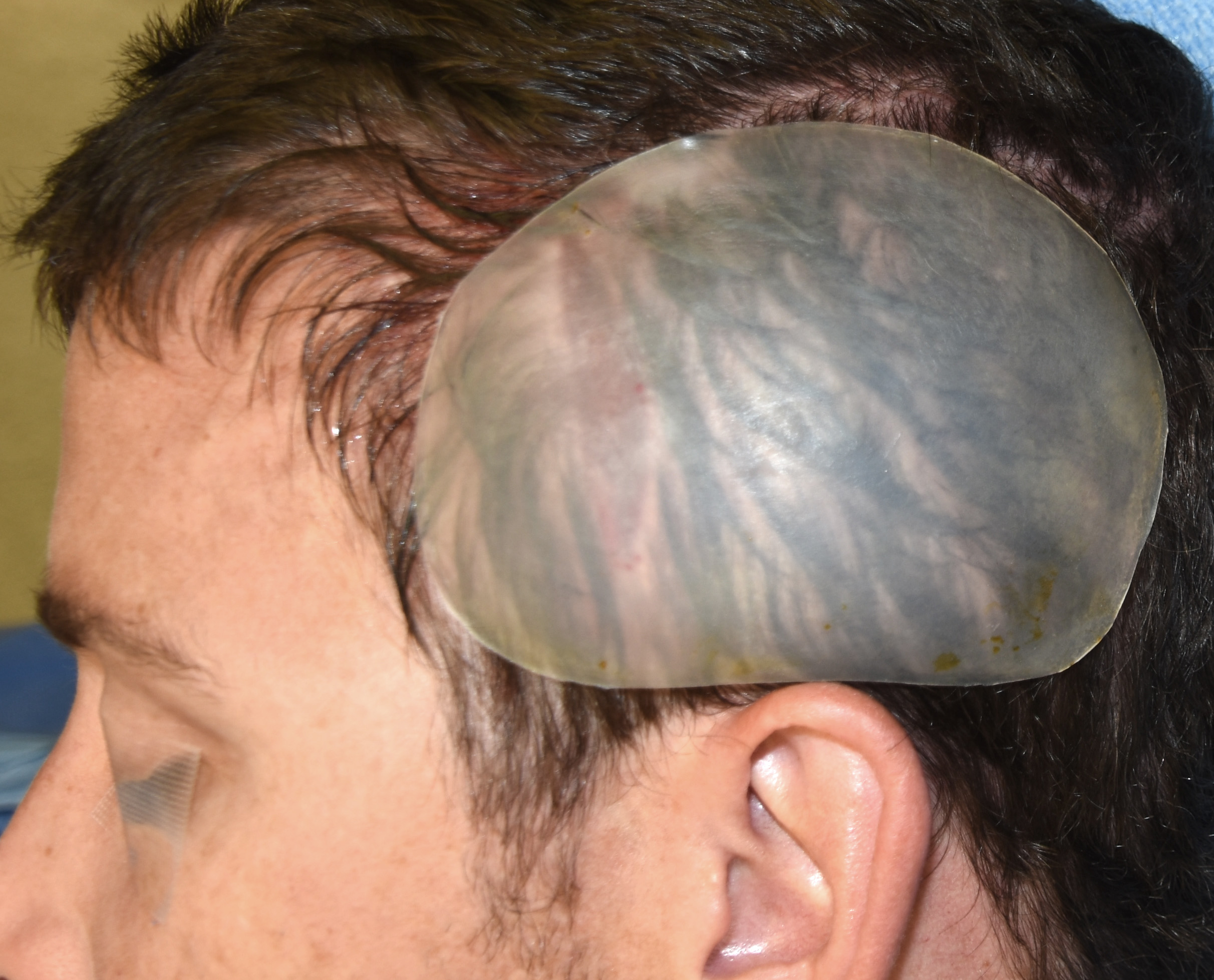 Head Widening Implant Dr Barry Eppley Indianapolis - Explore Plastic ...