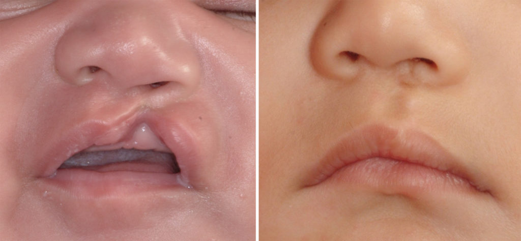 Plastic Surgery Case Study - Incomplete Cleft Lip Repair - Explore ...