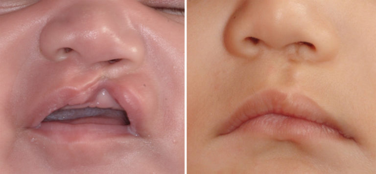 Plastic Surgery Case Study - Incomplete Cleft Lip Repair - Explore ...