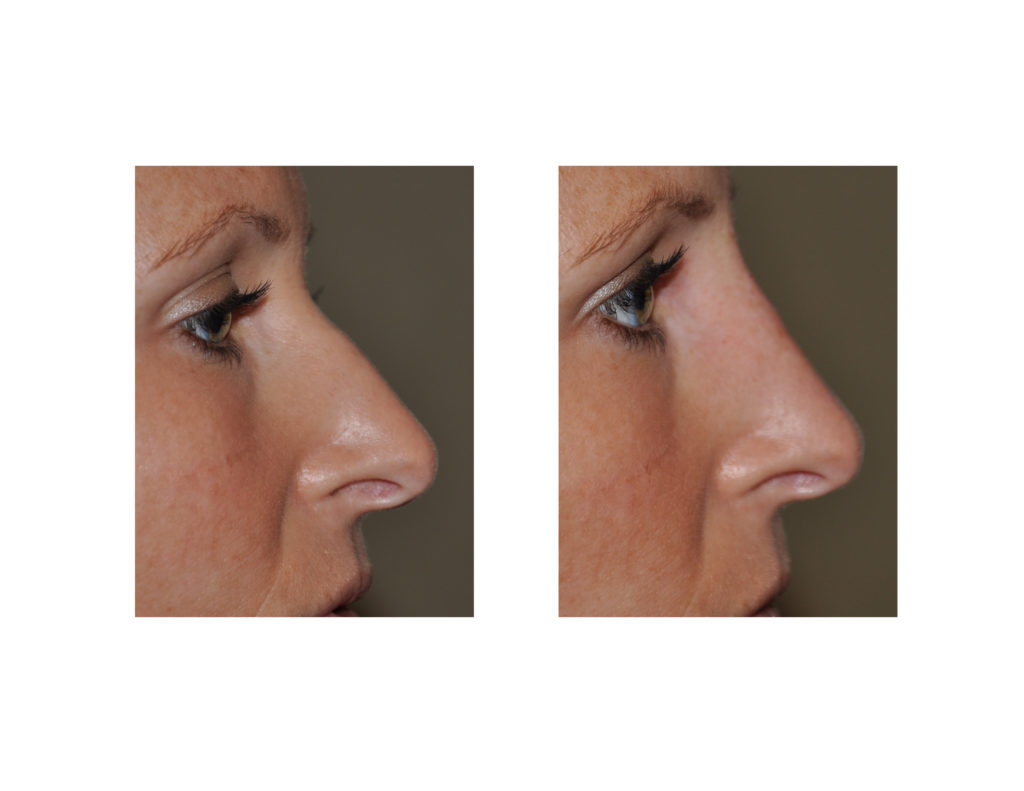 Strategies for Safe Injectable Filler Treatments to the Nose - Explore ...