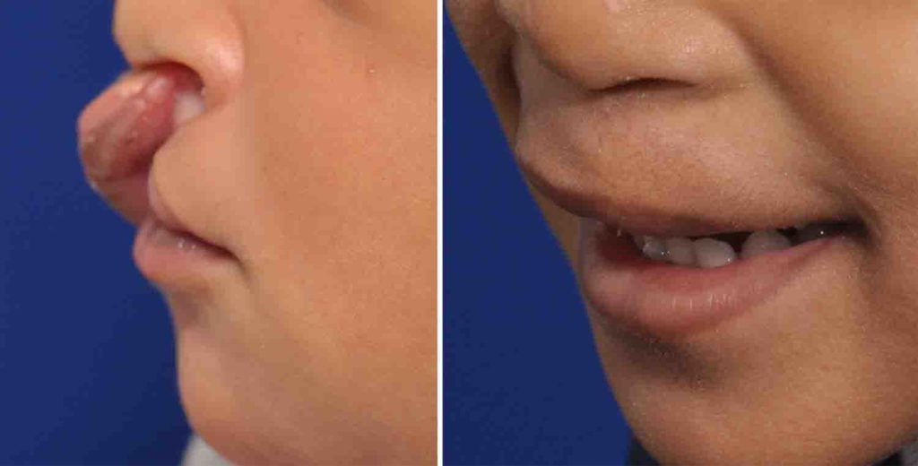 Left Cleft Lip Repair side view Dr Barry Eppley Indianapolis - Explore ...