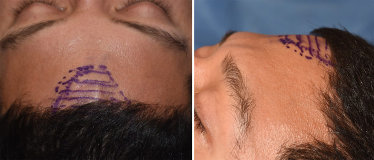 Plastic Surgery Case Study - Reduction of a Prominent Upper Forehead ...