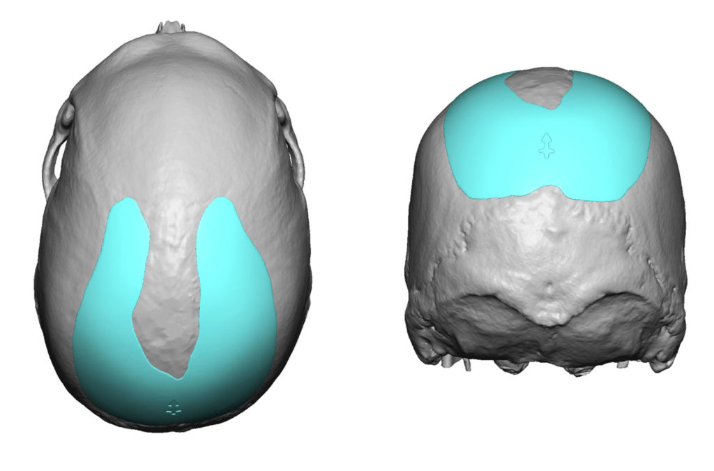 Plastic Surgery Case Study - Custom Occipital-Parasagittal Skull ...