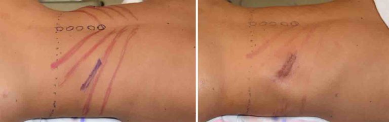 Improved Horizontal Waistline Narrowing with Rib and Muscle Removal ...