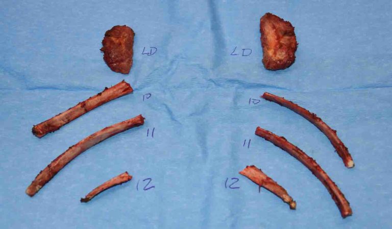 Improved Horizontal Waistline Narrowing with Rib and Muscle Removal ...