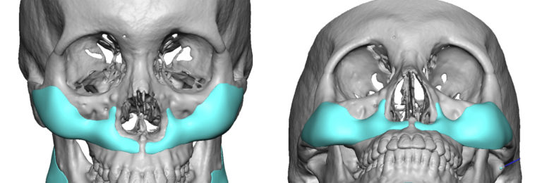 Midface Augmentation with a Custom Cheek-Maxillary-Paranasal Implant ...