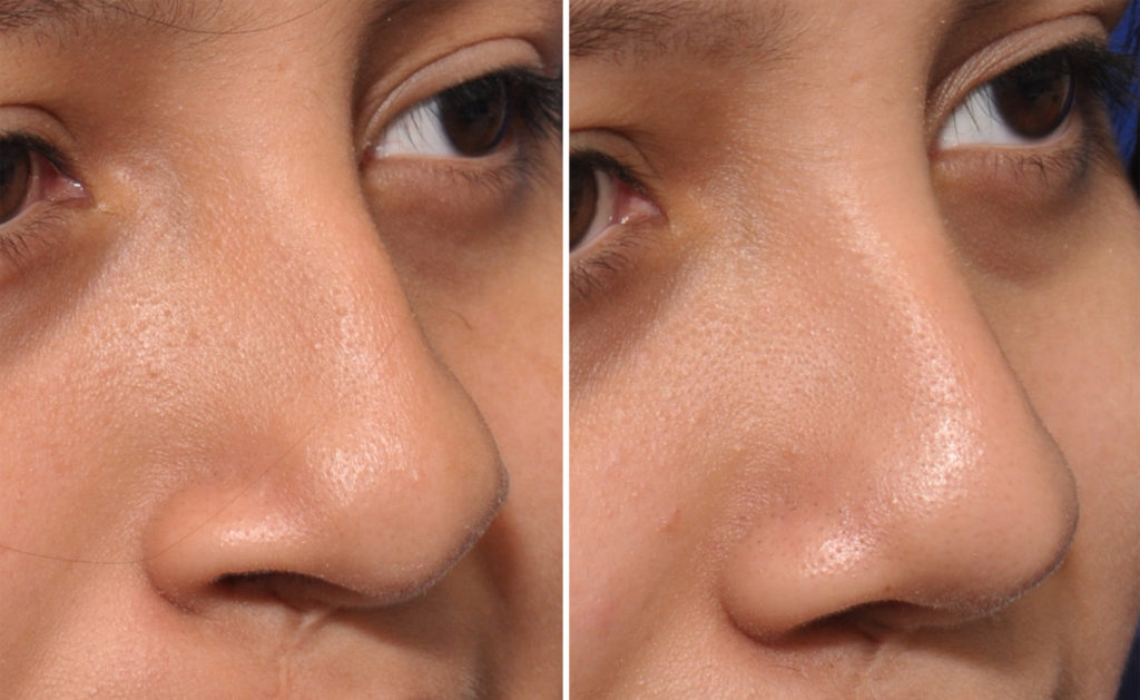 Plastic Surgery Case Study - Female Teenage Cleft Rhinoplasty - Explore ...