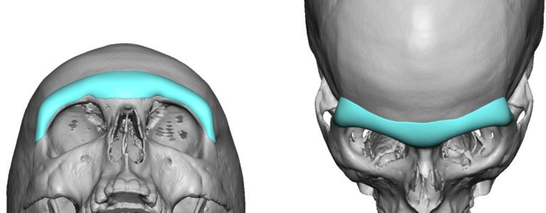 Masculinizing the Male Forehead with Custom Brow Bone Implants ...