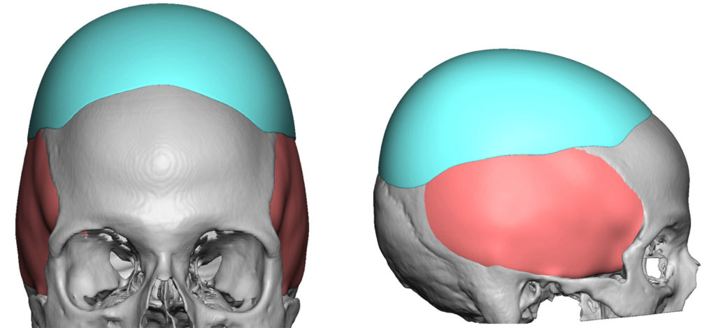 Plastic Surgery Case Study - Two-Stage Skull Augmentation with a Custom ...