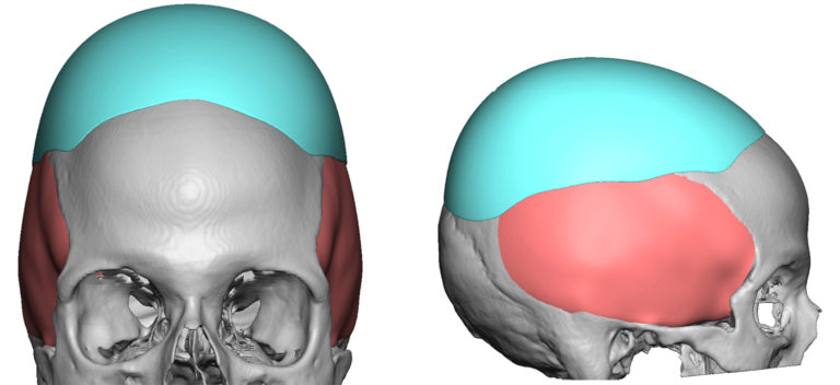 Plastic Surgery Case Study - Two-Stage Skull Augmentation with a Custom ...