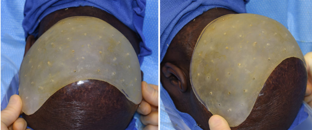 Plastic Surgery Case Study - Scalp Reconstruction with Custom Skull ...