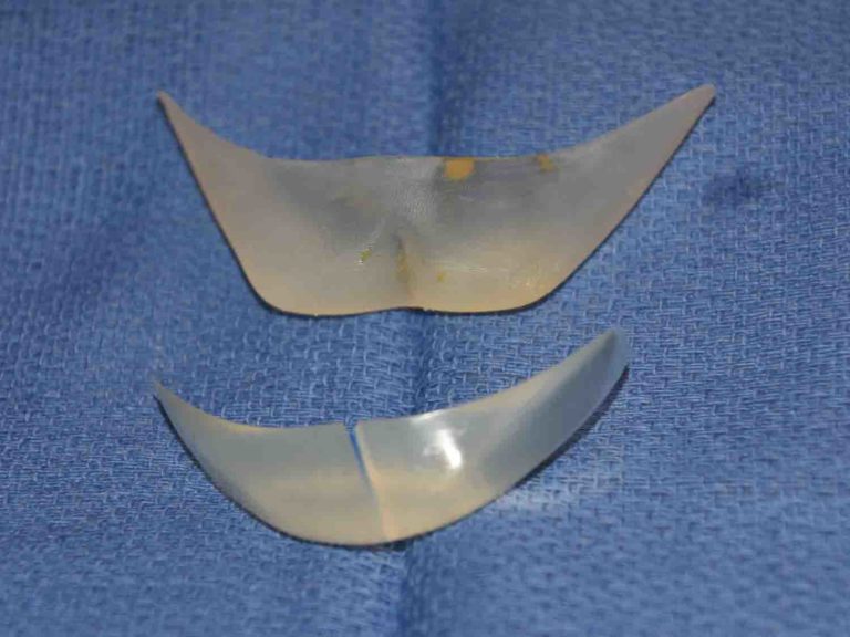 The Role of Custom Chin Implants in Aesthetic Facial Augmentation ...