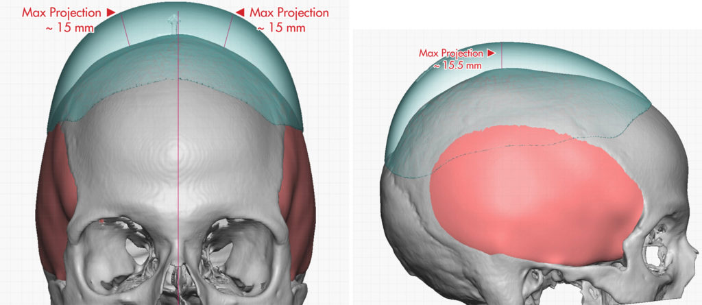 Plastic Surgery Case Study - Two-Stage Skull Augmentation with a Custom ...