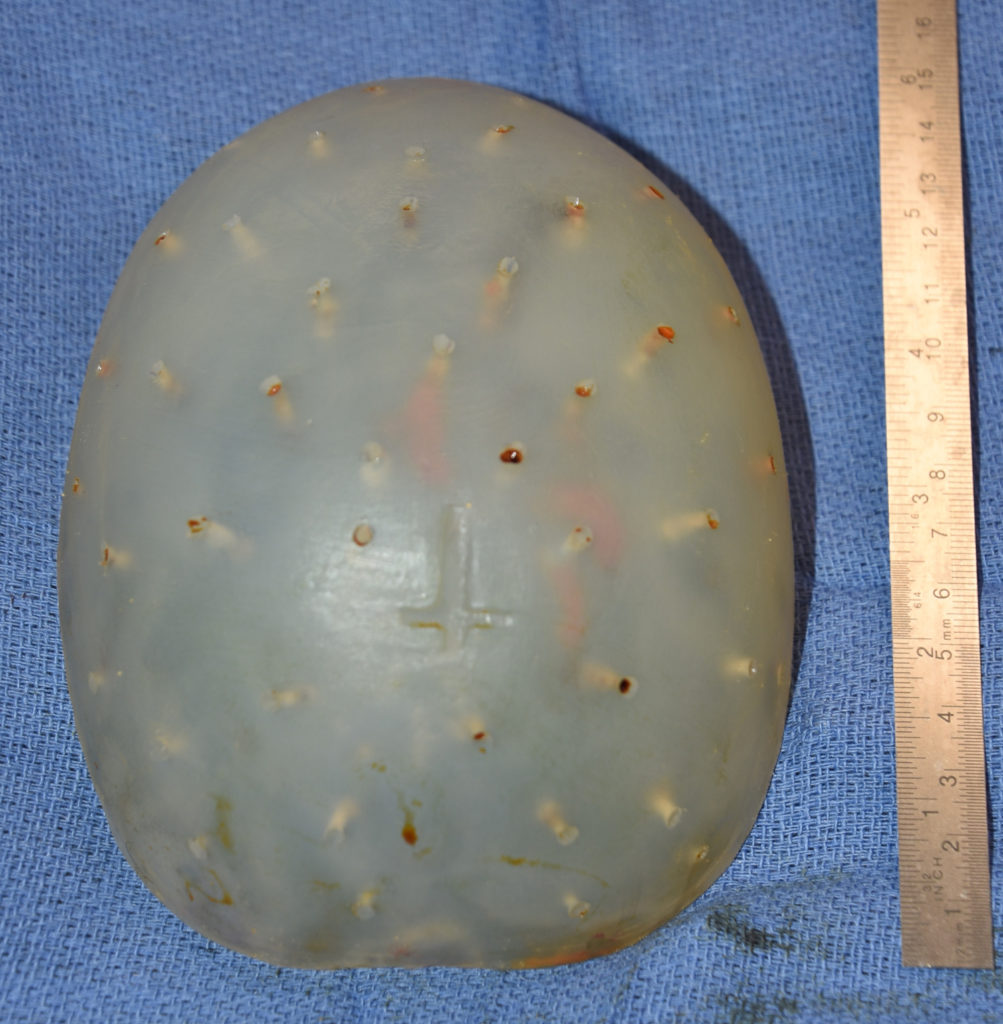 Flat Head Custom Skull Implant intraop Dr Barry Eppley Indianapolis ...