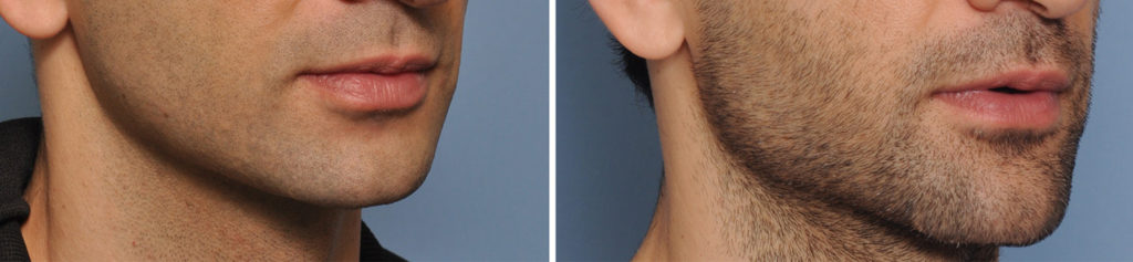 Plastic Surgery Case Study - Custom Jawline Defining Implant - Explore ...