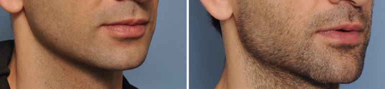 Plastic Surgery Case Study - Custom Jawline Defining Implant - Explore ...