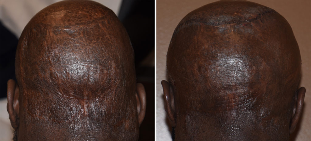 Plastic Surgery Case Study - Scalp Reconstruction with Custom Skull Implant - Explore Plastic ...