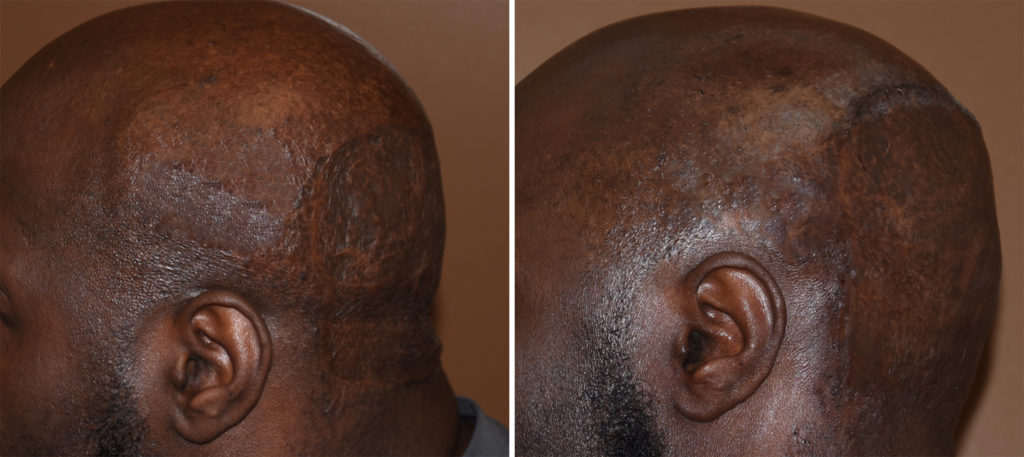Plastic Surgery Case Study - Scalp Reconstruction with Custom Skull Implant - Explore Plastic ...