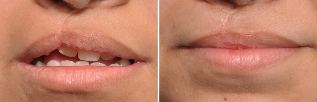 Plastic Surgery Case Study - Cleft Lip Revision with Buccal Fat Graft ...