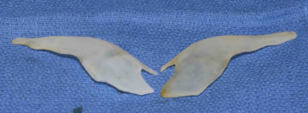 The Model Cheek Implant (Malar-Arch Design) for the High Cheekbone Look ...