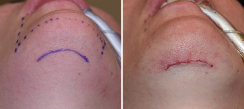 OR Snapshots - Liimting the Incision Length in Submental Chin Reduction ...