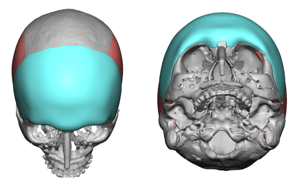Plastic Surgery Case Study - Custom Forehead-Temporal Implant ...