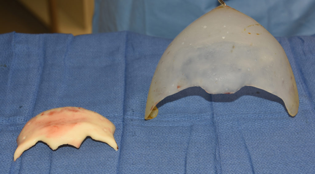 Plastic Surgery Case Study - Custom Forehead-Temporal Implant ...