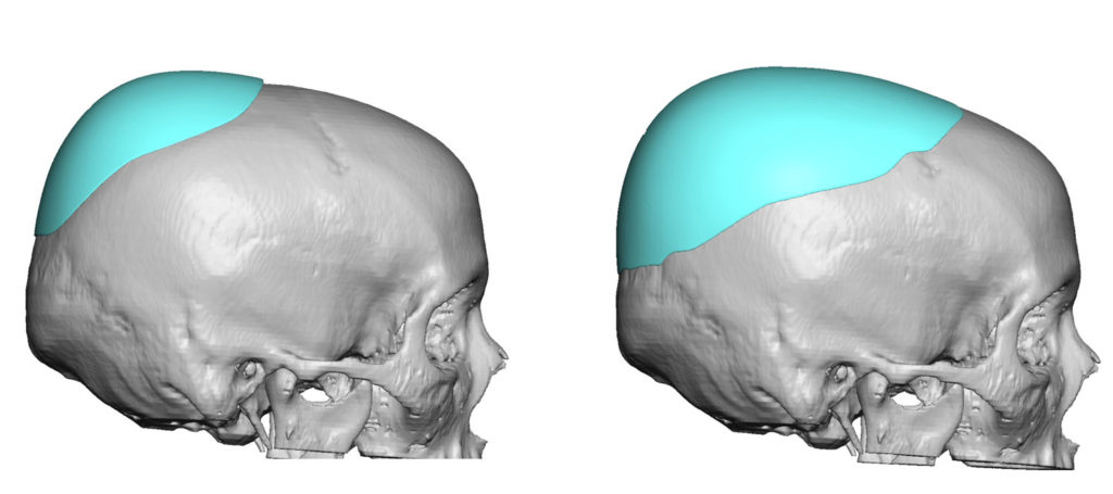 Plastic Surgery Case Study - Custom Skull Implant Replacement for ...