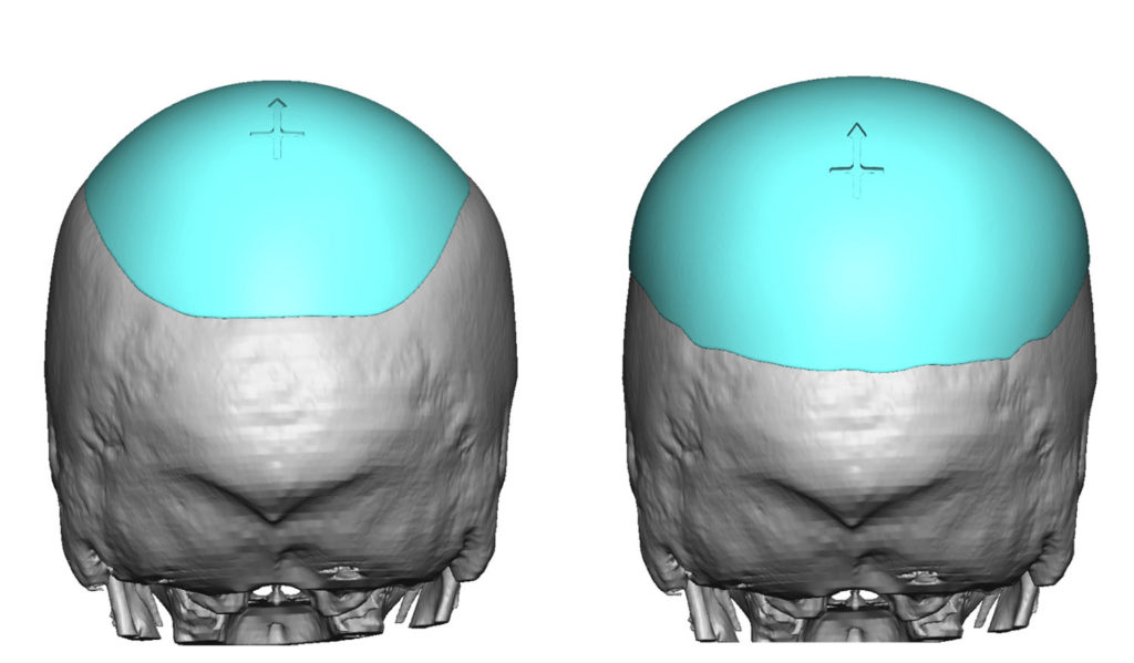 Plastic Surgery Case Study - Custom Skull Implant Replacement for ...