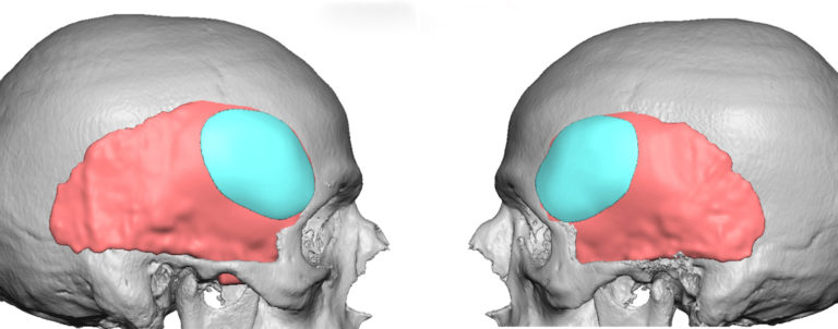 The Design of the Forehead Widening Temporal Implant - Explore Plastic ...