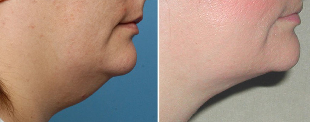 Kybella Injections for Neck Fat Reduction - Explore Plastic Surgery