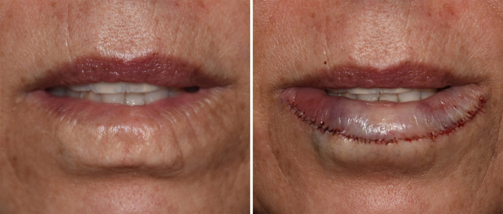 Lower Lip Advancement for Hemangioma result front view Dr Barry Eppley ...