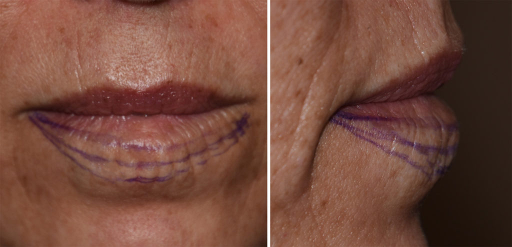 Plastic Surgery Case Study - Lower Lip Advancement for Subtotal ...