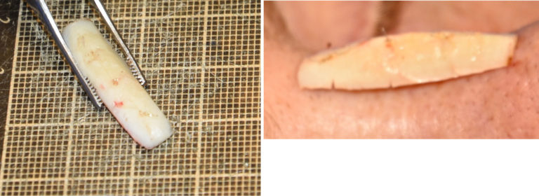 Technical Strategies - Rib Graft Shaping in Augmentative Rhinoplasty ...