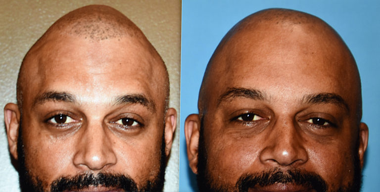 Sagittal Skull Correction Dr Barry Eppley Indianapolis - Explore ...