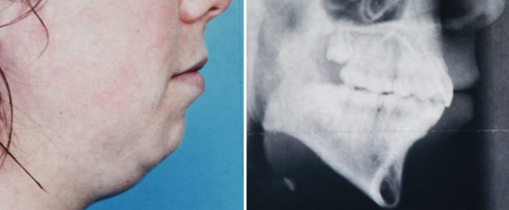 Plastic Surgery Case Study - Severe Double Chin Correction with Sliding ...