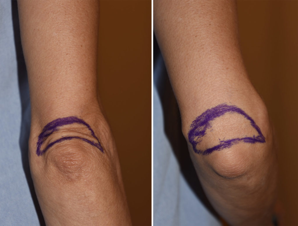 Plastic Surgery Case Study - Elbow Lifts for Saggy Elbow Skin - Explore ...