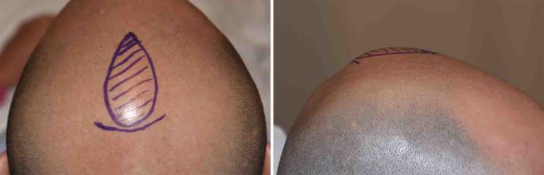 Plastic Surgery Case Study - Posterior Sagittal Crest Reduction Through ...
