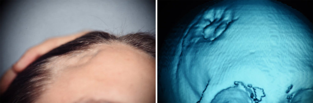 Plastic Surgery Case Study - Hydroxyapatite Granule Skull ...